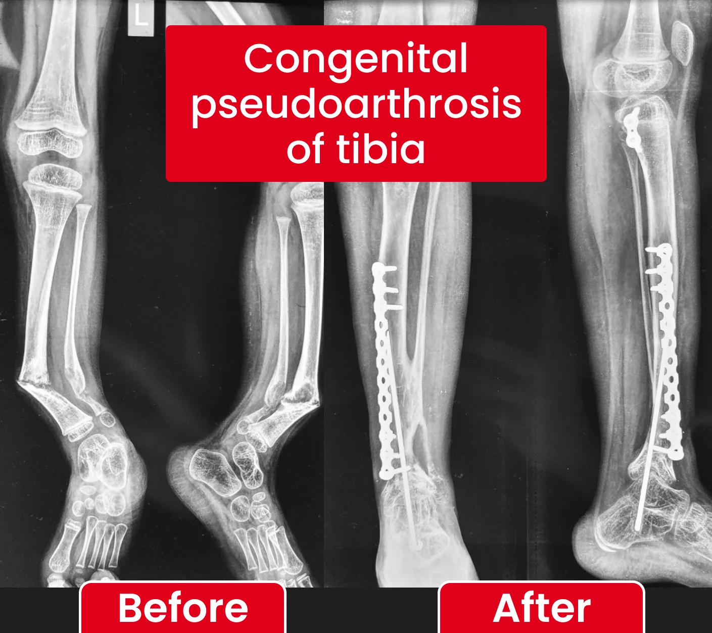 Congenital Limb Deformities – Dr Manjush Ramesh Halbhavi